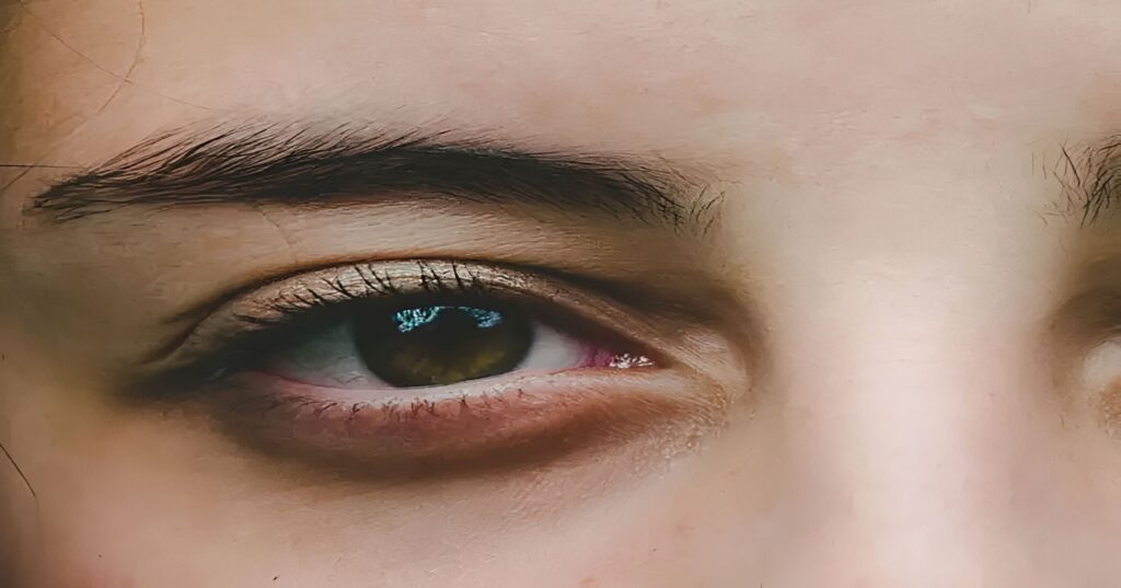 ¿Qué son las ojeras y que tratamientos recomendamos? - DermaMedic